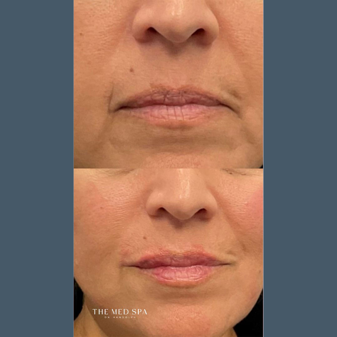 Lip Filler in Crown Point, IN | The Med Spa on Randolph